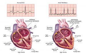 Atrial Fibrillation - Ganiyu Oshodi, MD - Temecula Heart Specialist
